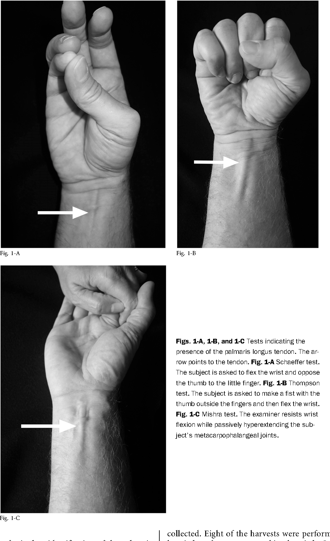 Pdf Median Nerve Compression And The Reversed Palmaris Longus My Xxx