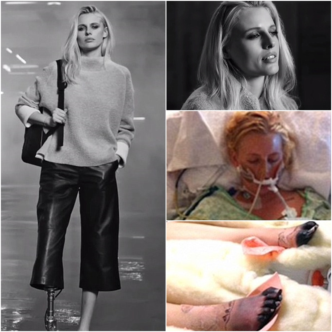 Model Who Lost Her Leg To Toxic Shock Syndrome Reveals She Is Going To